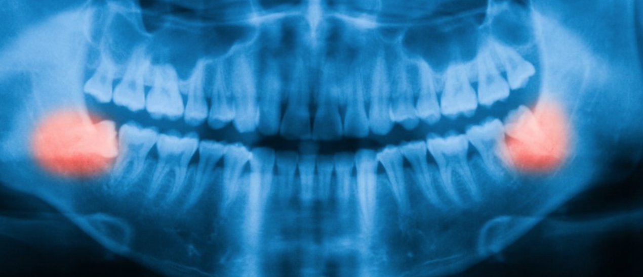 The Whole Truth About Your Wisdom Teeth that No Dentist Will Tell You ...